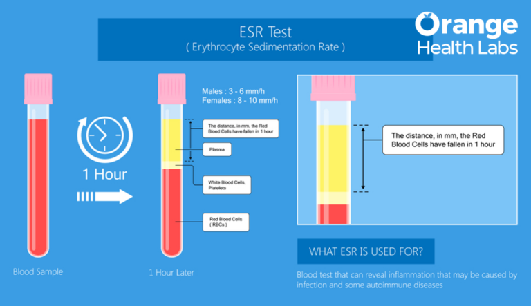 High ESR Levels: Causes, Symptoms, and Significance