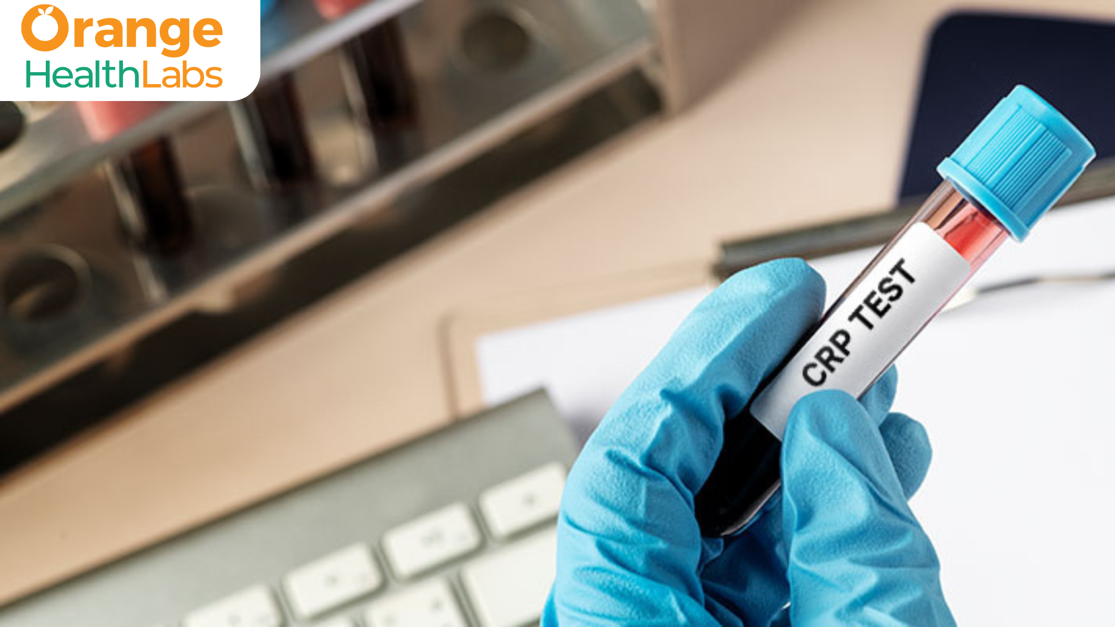 Which Tests Are Done for Typhoid? A Complete Guide to Diagnosis and ...